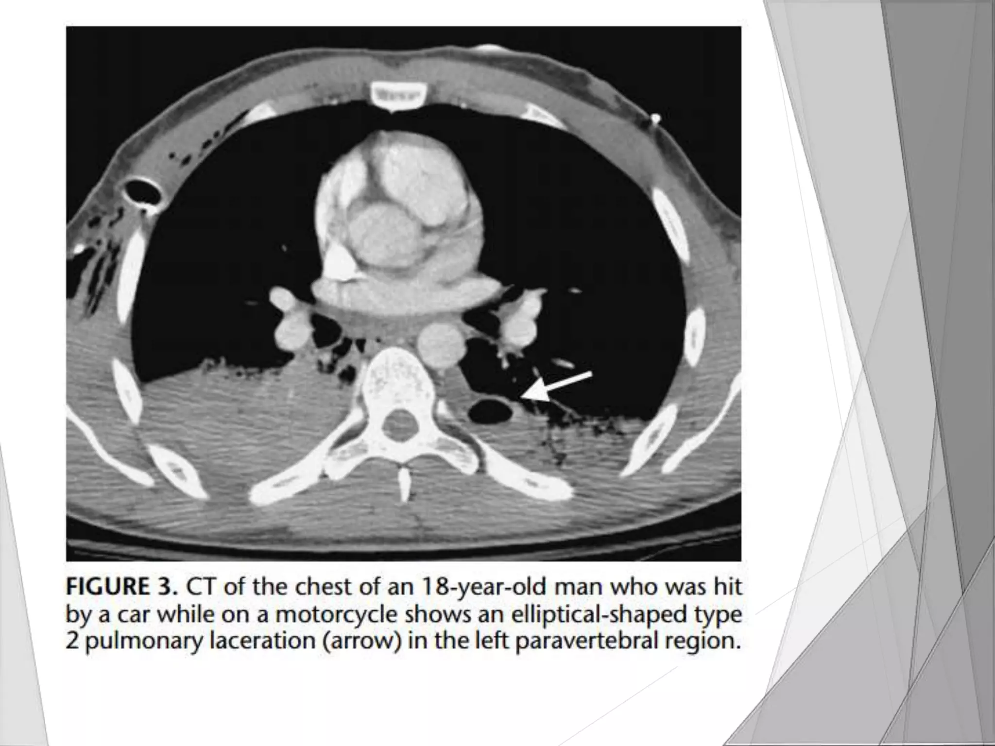 Pulmonary trauma | PPT
