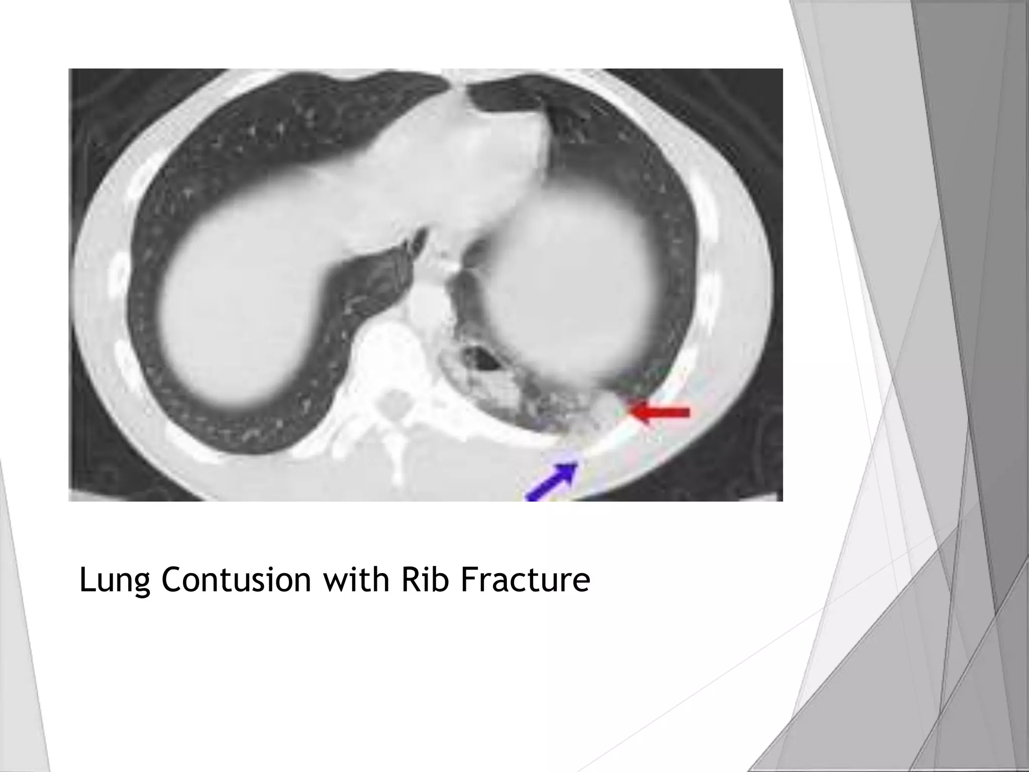 Pulmonary trauma | PPT
