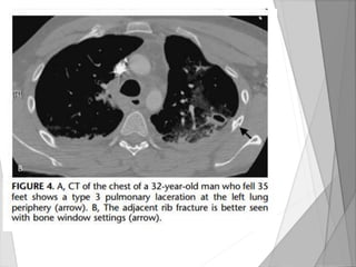 Pulmonary trauma | PPT