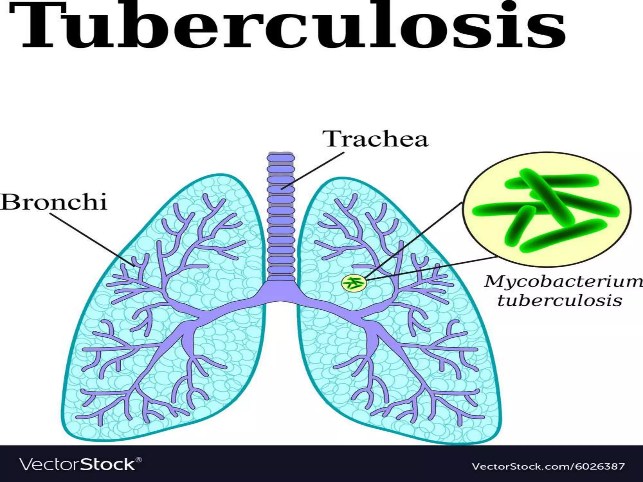 Pulmonary tuberclosis | PDF