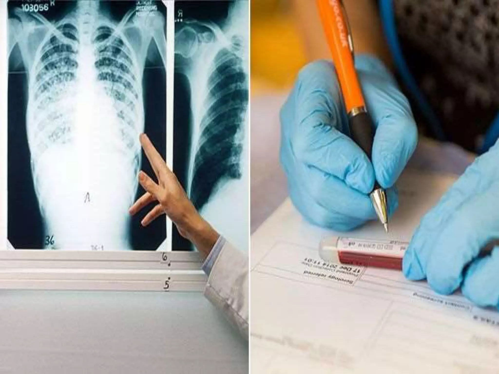 Pulmonary tuberclosis | PDF