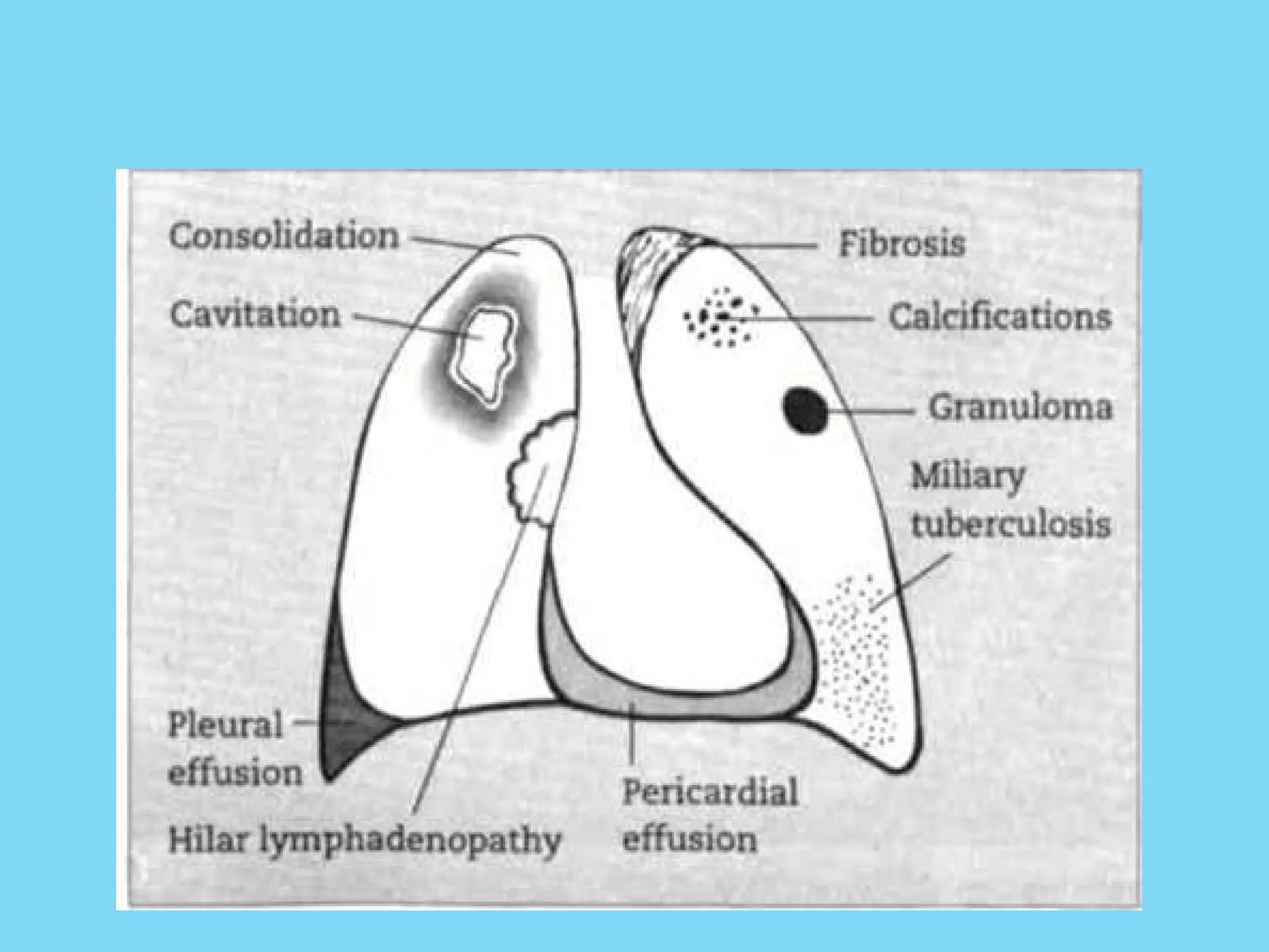 Pulmonary tuberculoma | PPT | Free Download