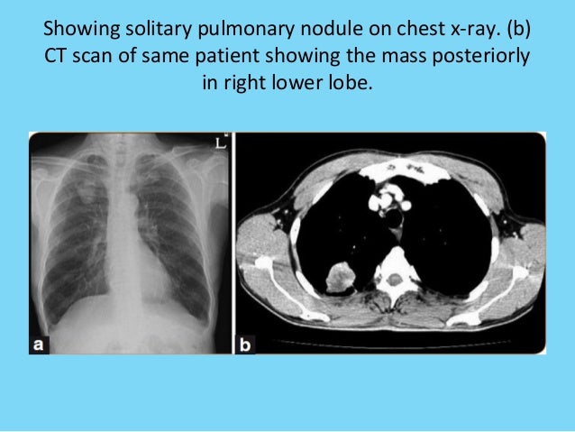 Pulmonary tuberculoma