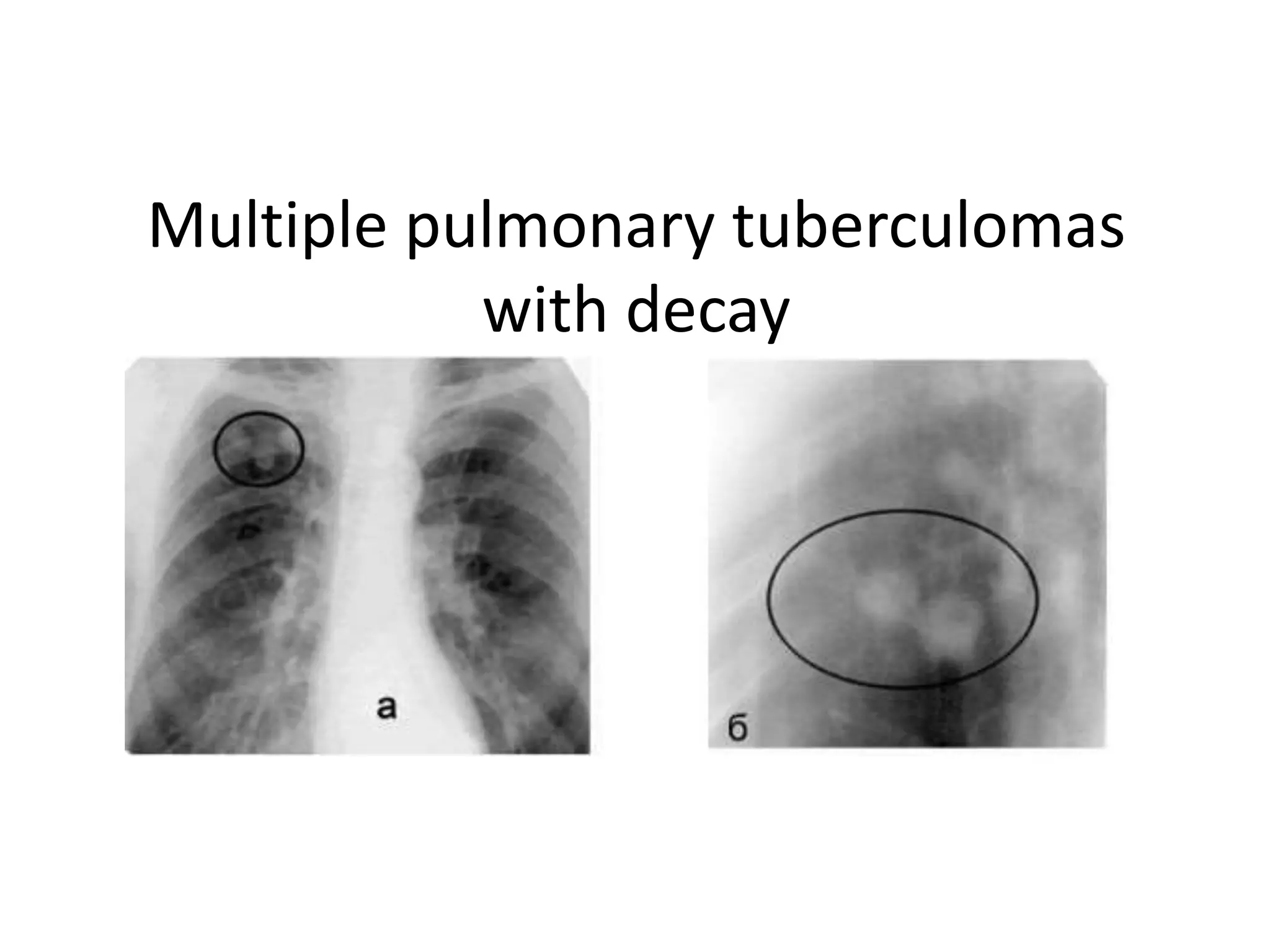 Pulmonary tuberculoma | PPTX