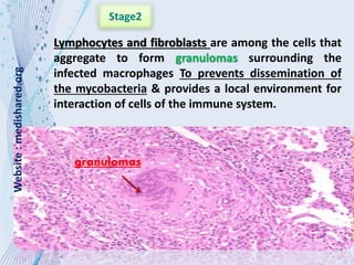Pulmonary Tuberculosis Part 1 | PPTX