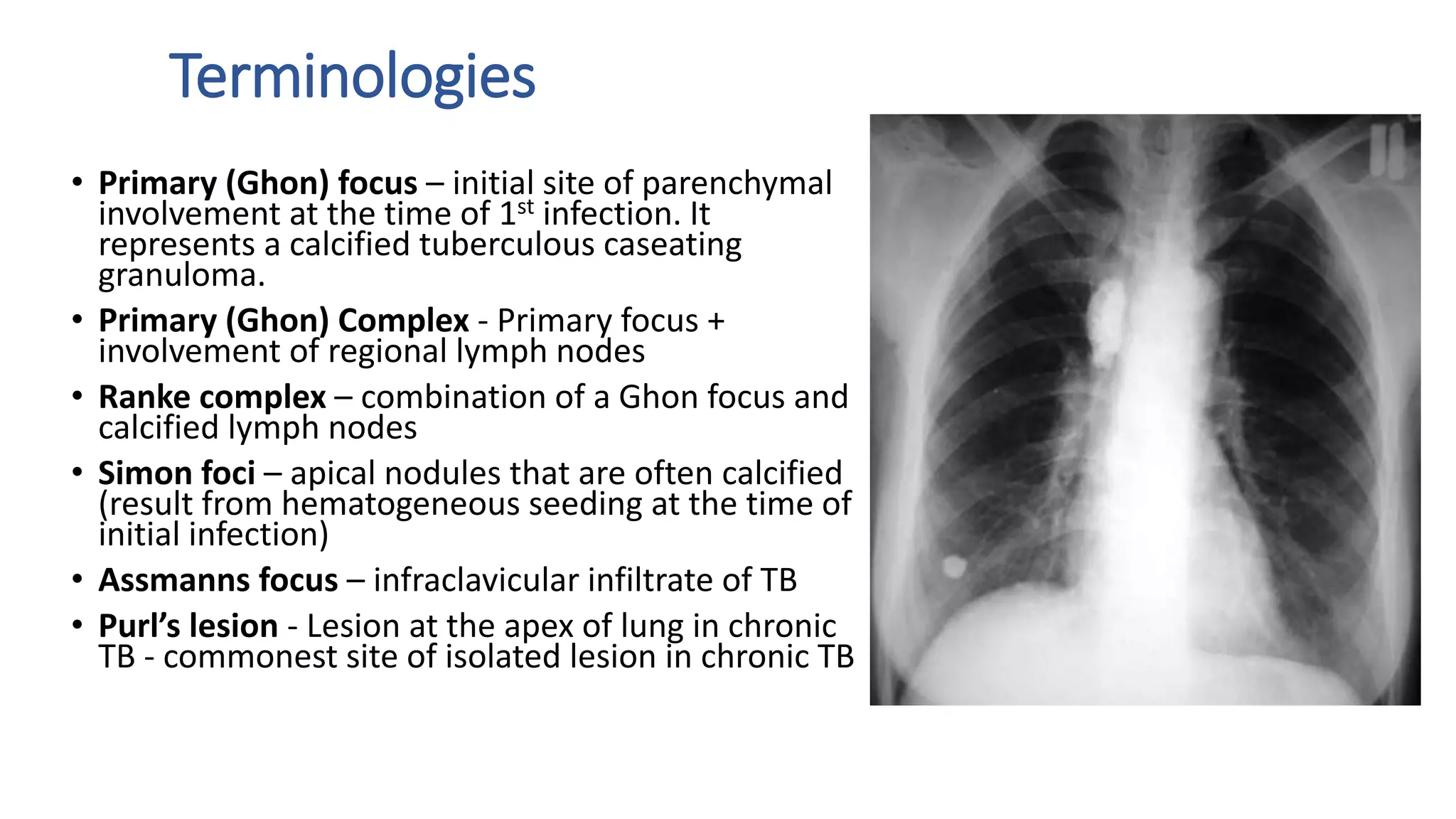 Pulmonary tuberculosis | PPTX