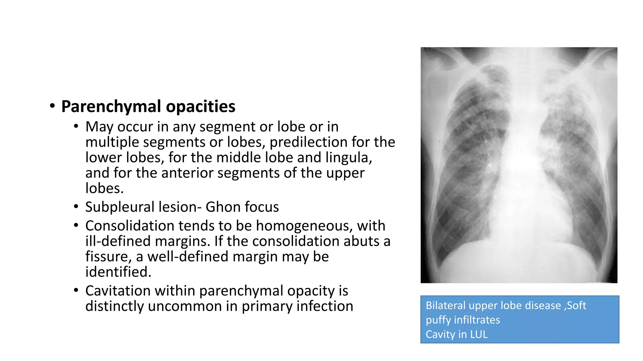 Pulmonary tuberculosis | PPTX