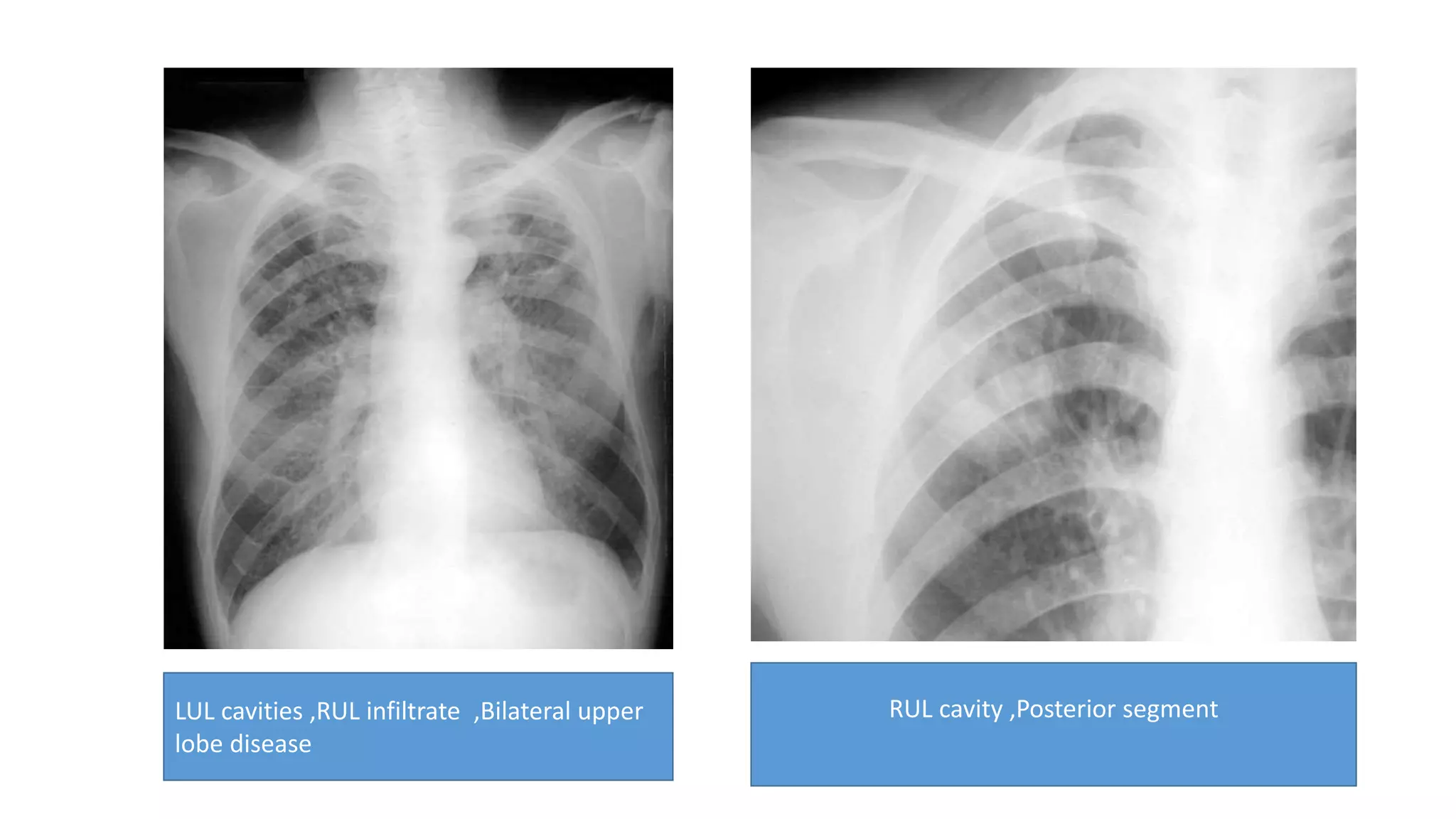 Pulmonary tuberculosis | PPTX