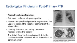 Pulmonary tuberculosis | PPTX