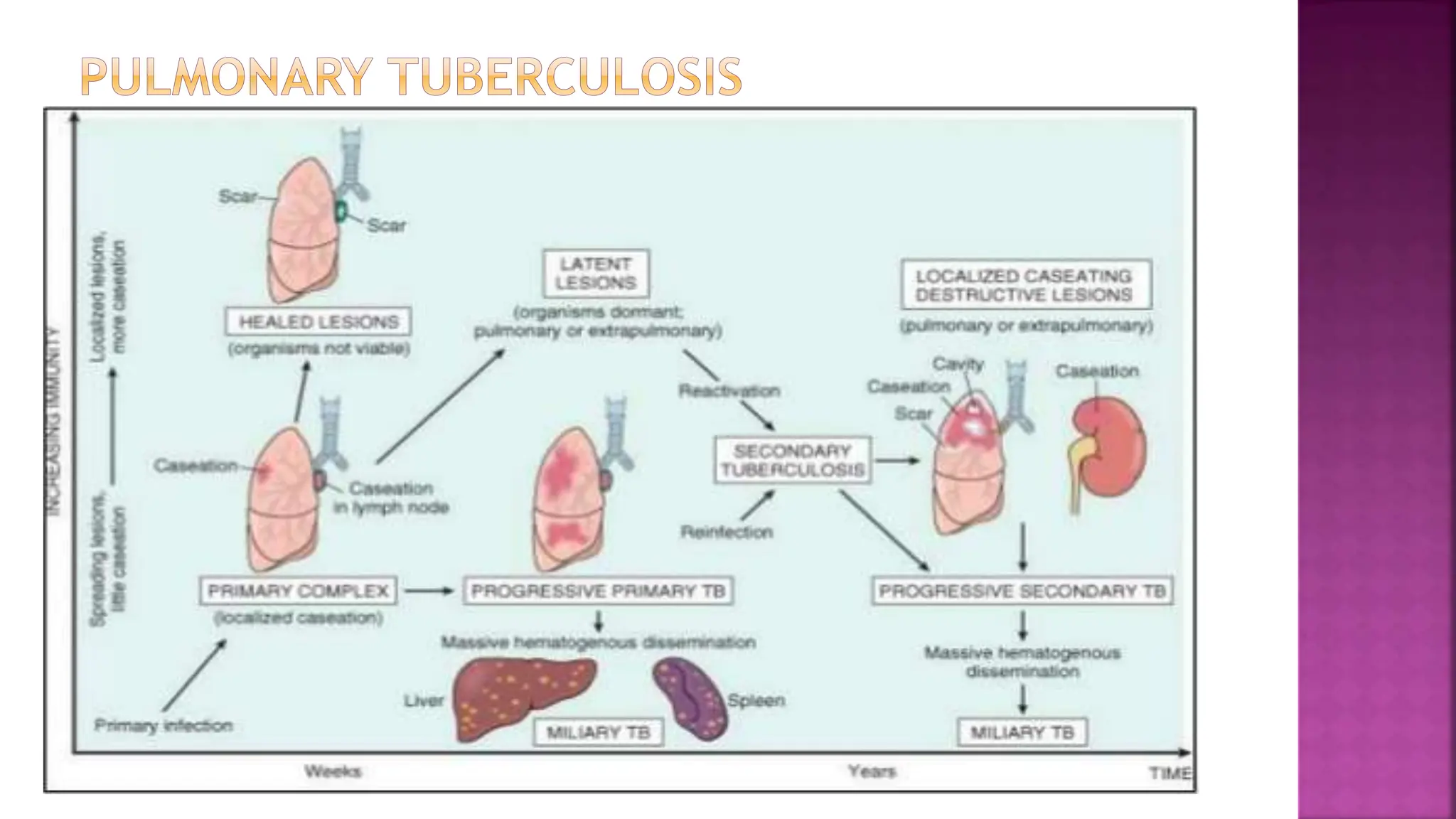 Kampala International University PULMONARY TUBERCULOSIS.pptx