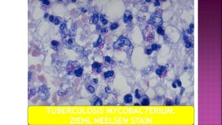 Kampala International University PULMONARY TUBERCULOSIS.pptx