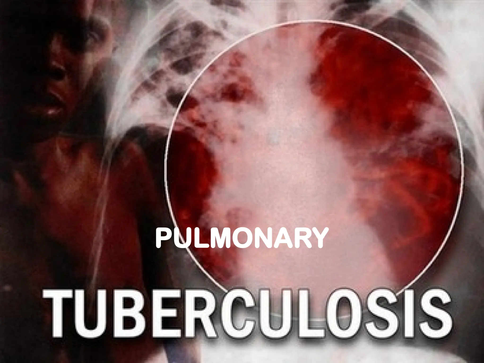 Pulmonary Tuberculosis-The Philippines is among the 22 high-burdened ...
