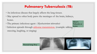 Pulmonary tuberculosis (tb), | PPTX