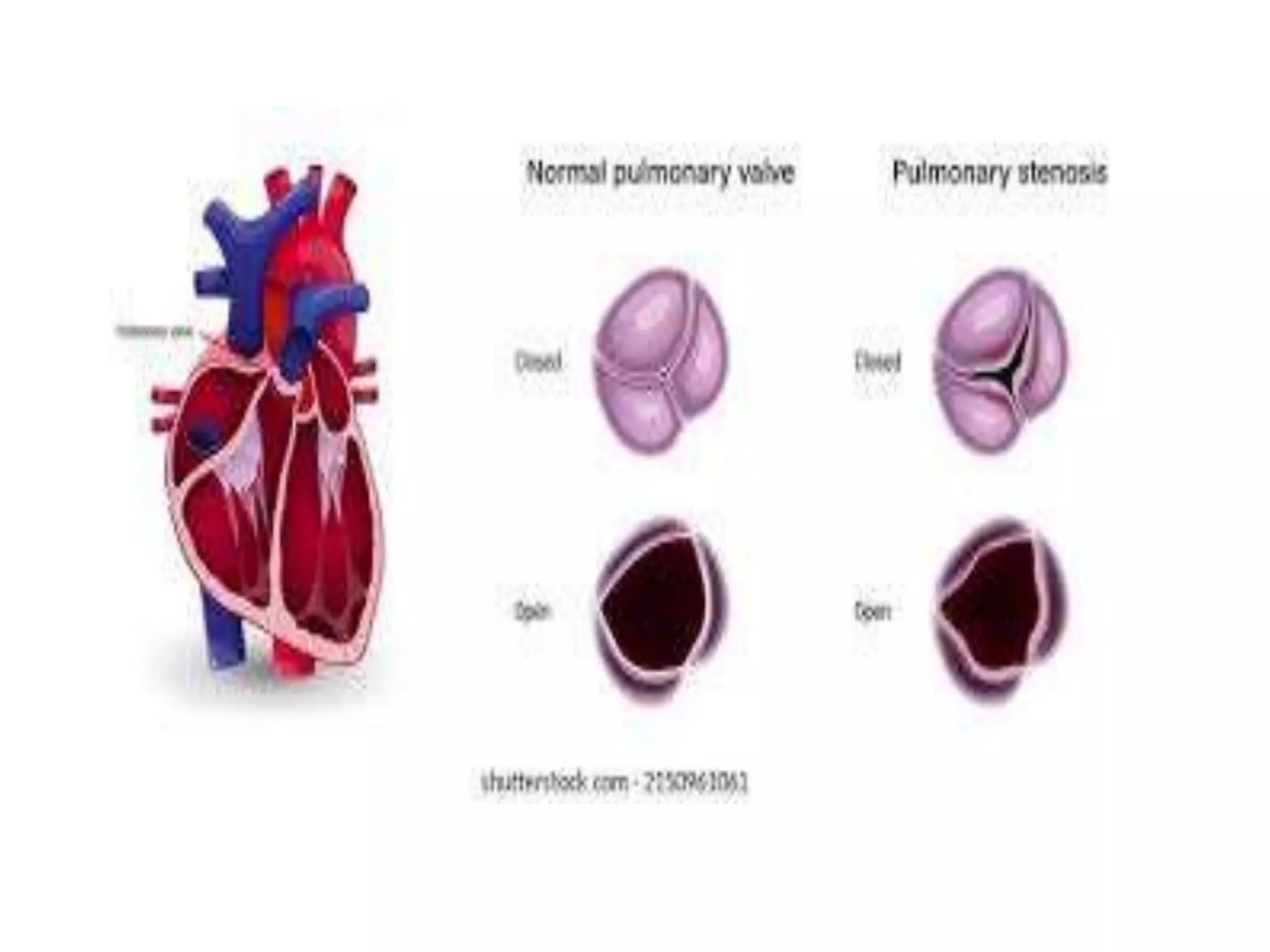 PULMONARY VALVE DISEASES.pptx