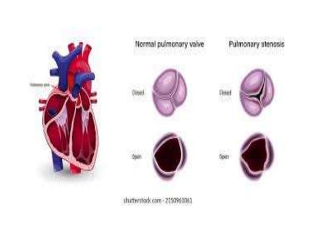 PULMONARY VALVE DISEASES.pptx | Heart and Cardiovascular Diseases ...