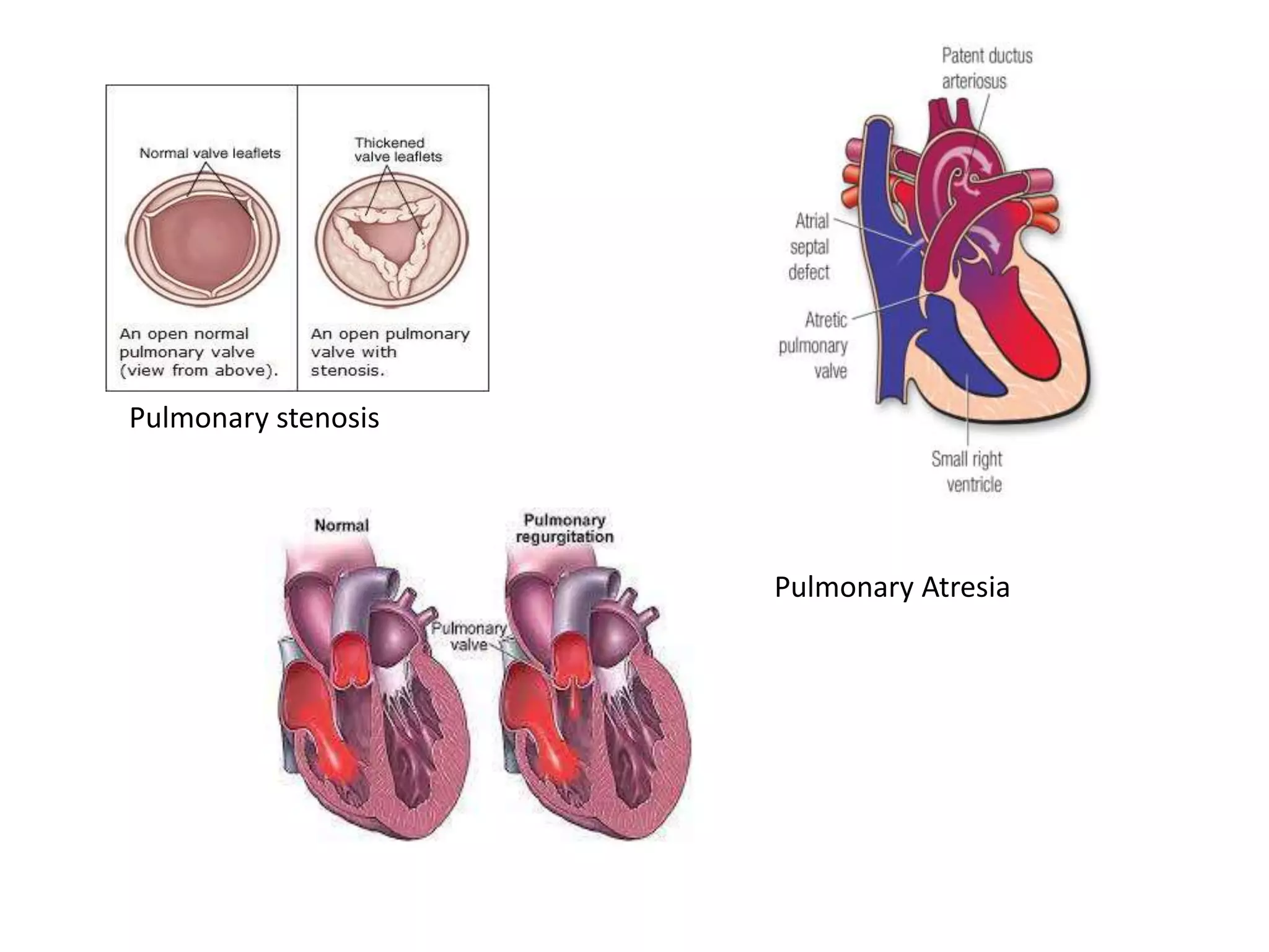 PULMONARY VALVE DISEASES (2).pptx
