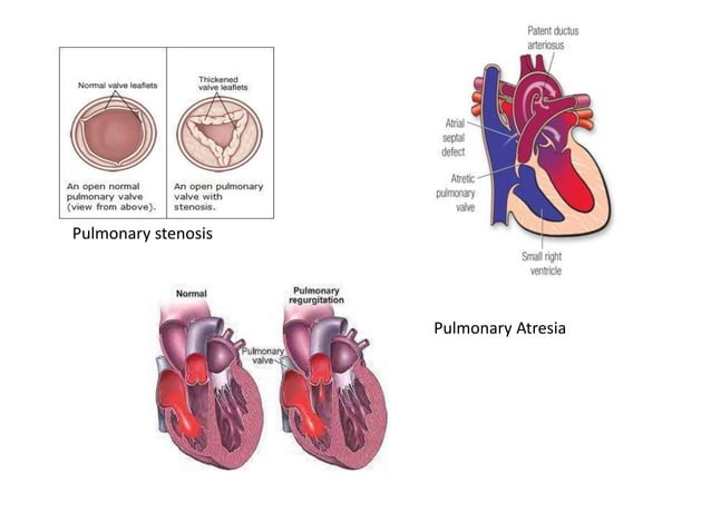 PULMONARY VALVE DISEASES (2).pptx | Heart and Cardiovascular Diseases ...