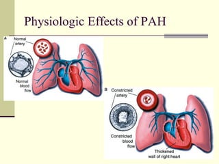 Pulmonary vascular disease / Pulmoary hypertension | PPT | Heart and ...