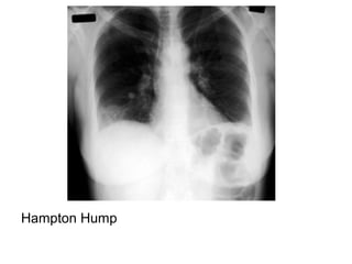 Diagnostic Imaging of Pulmonary Vasculature | PPT