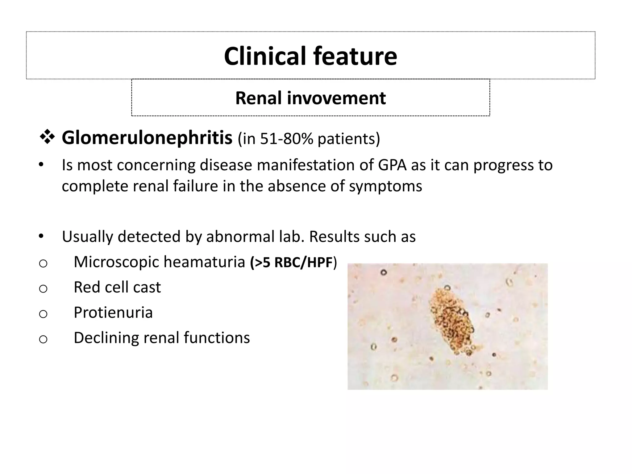 Pulmonary vasculitis(wegner,s granulomatosis) | PPTX
