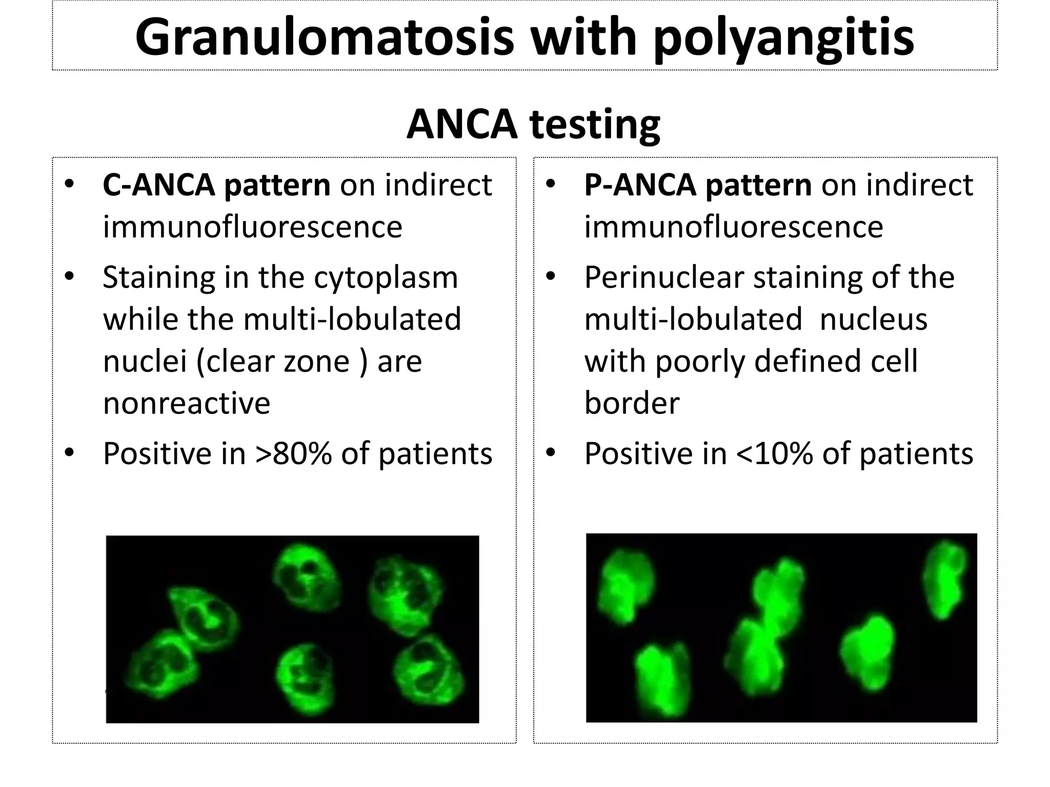 Pulmonary vasculitis(wegner,s granulomatosis) | PPTX
