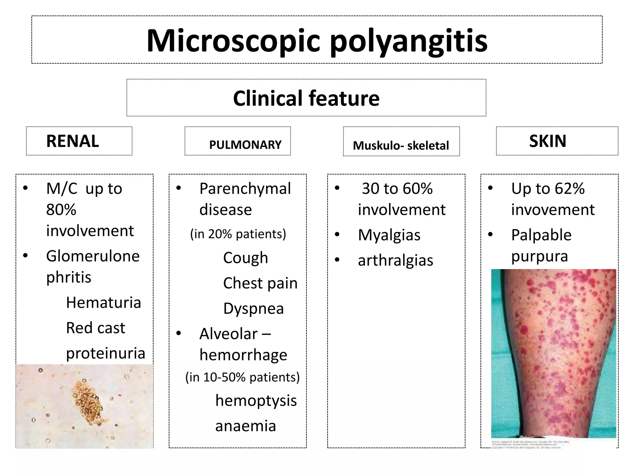 Pulmonary vasculitis(wegner,s granulomatosis) | PPTX