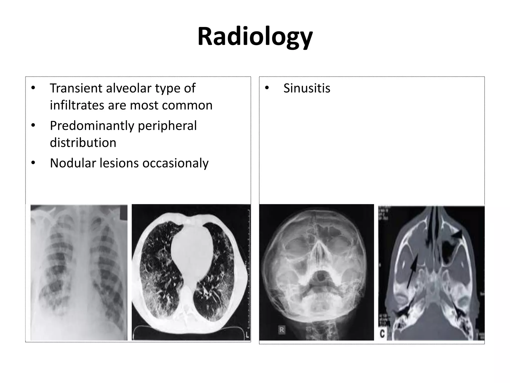 Pulmonary vasculitis(wegner,s granulomatosis) | PPTX