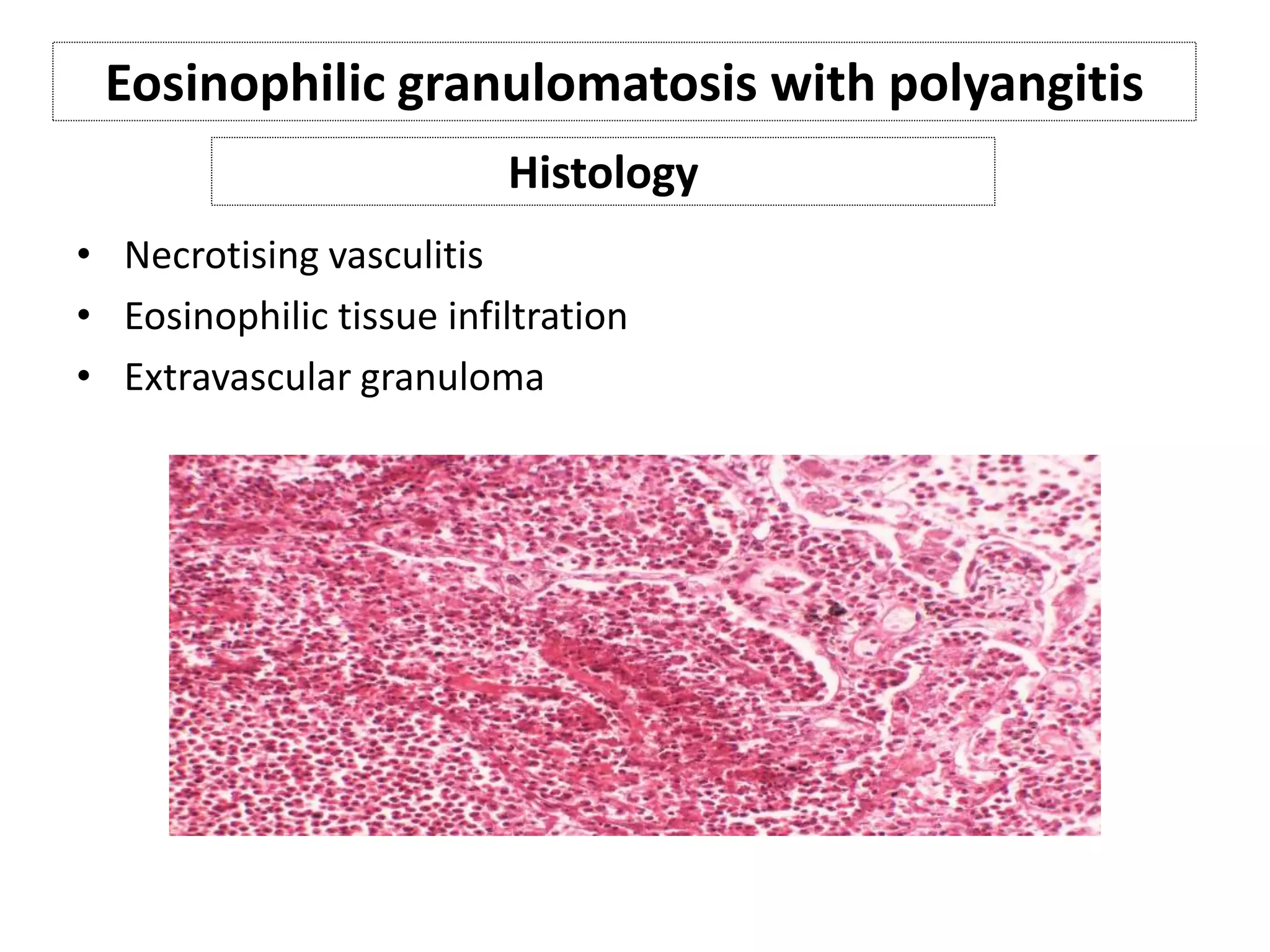 Pulmonary vasculitis(wegner,s granulomatosis) | PPTX