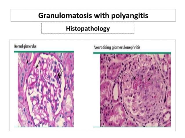 Pulmonary vasculitis(wegner,s granulomatosis) | PPTX