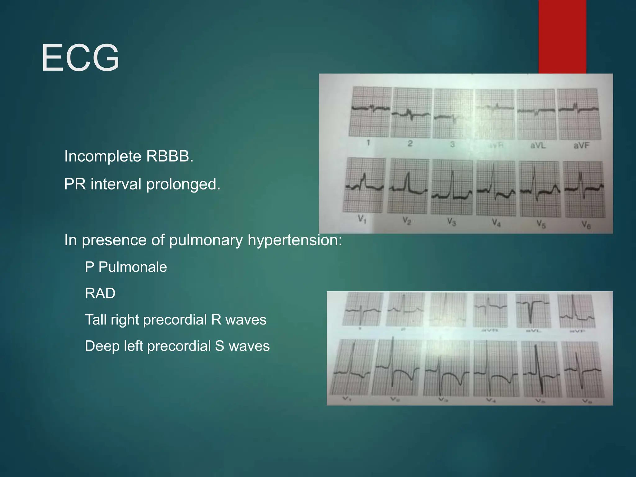 PULMONARY VENOUS ANOMALIES by Dr reyaz fayaz | PPTX