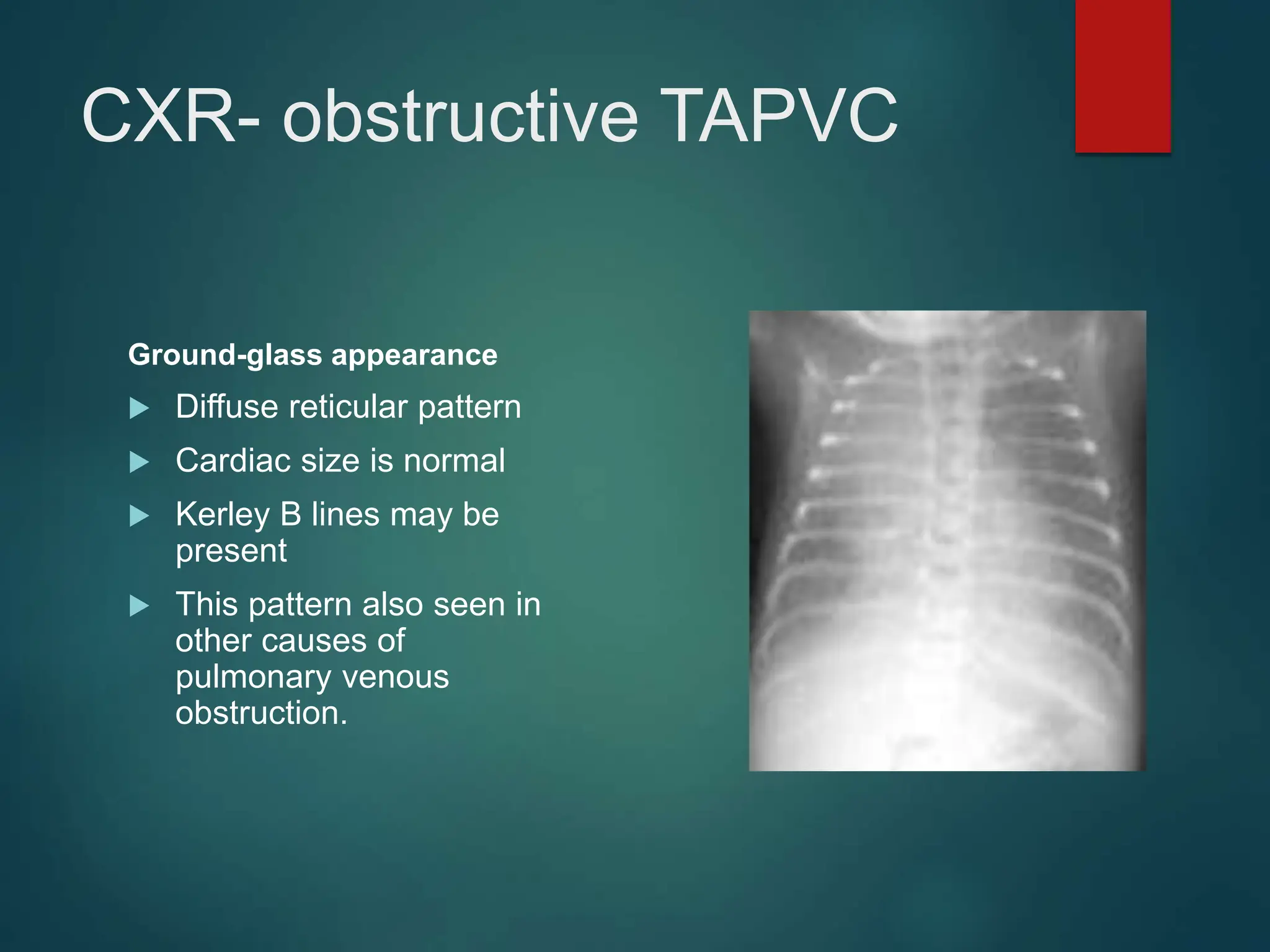 PULMONARY VENOUS ANOMALIES by Dr reyaz fayaz | PPTX