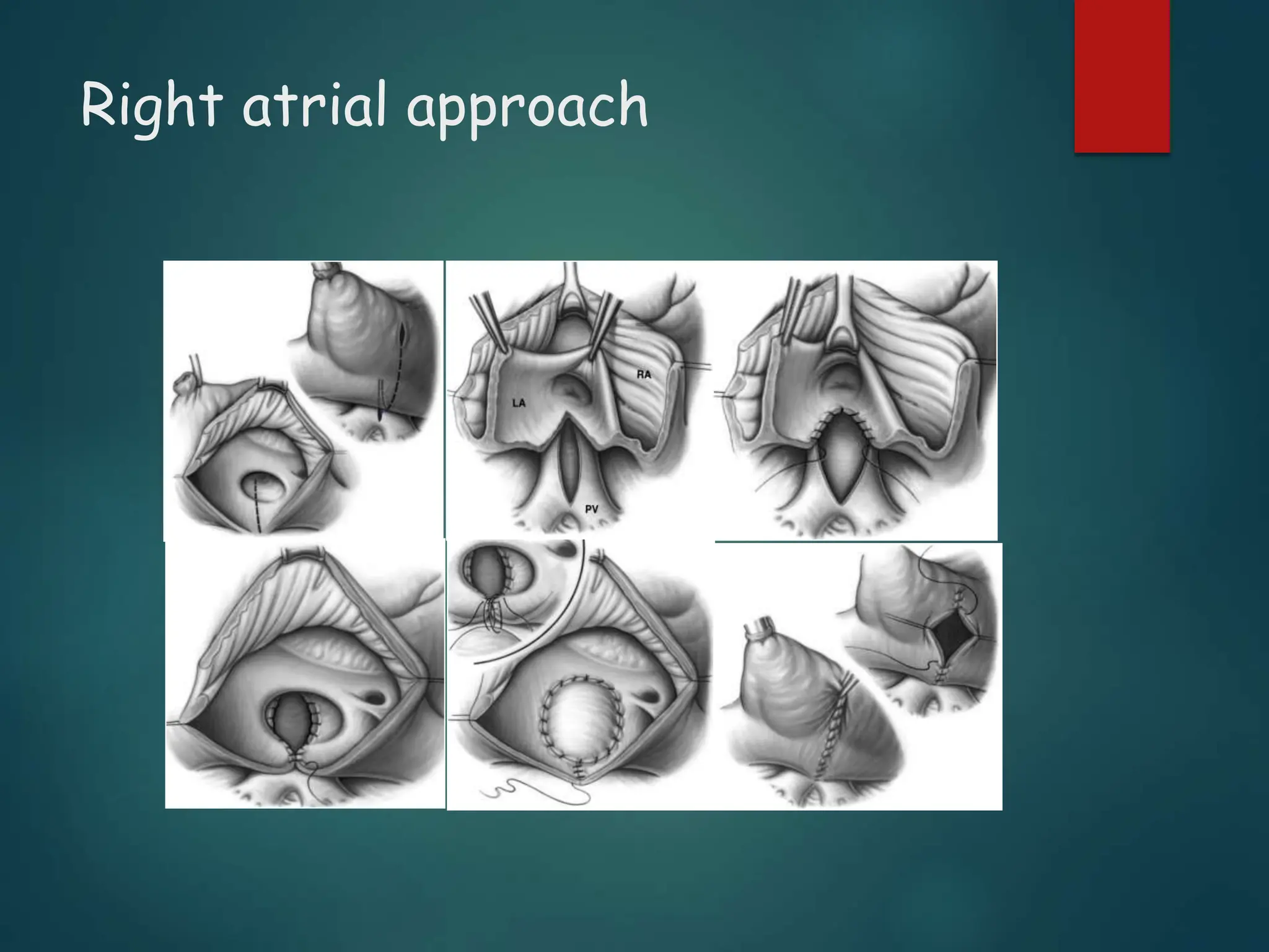 PULMONARY VENOUS ANOMALIES by Dr reyaz fayaz | PPTX