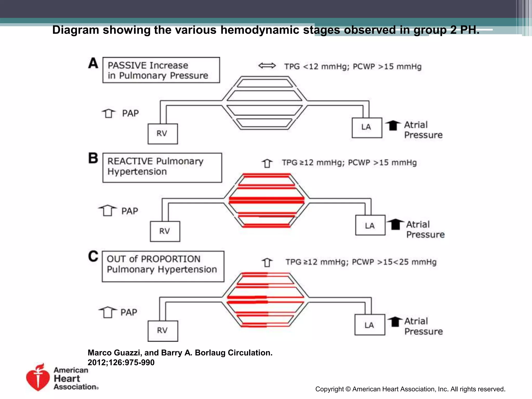 Pulmonary venous hypertension stages & skiagraphic changes | PPTX