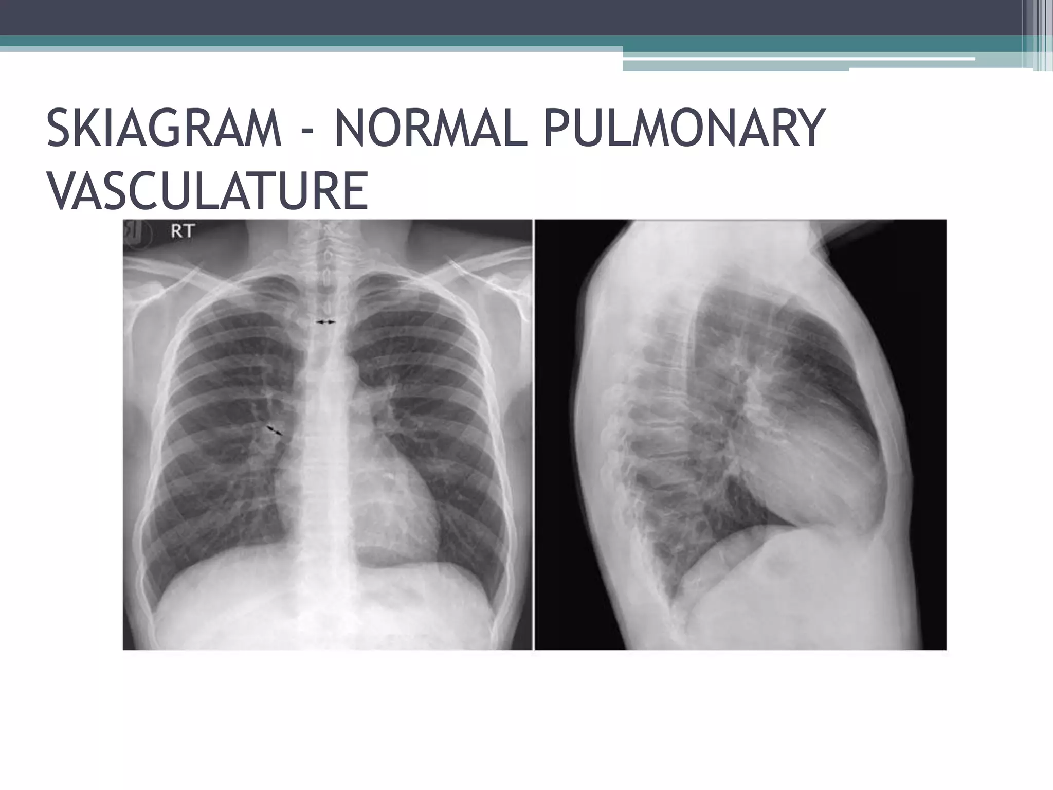 Pulmonary venous hypertension stages & skiagraphic changes | PPTX