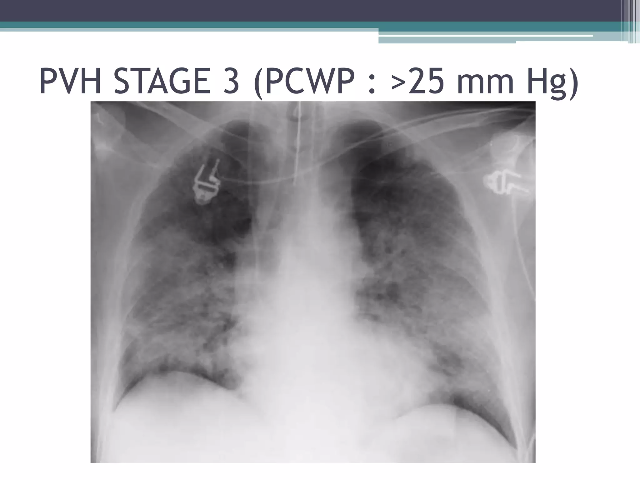 Pulmonary venous hypertension stages & skiagraphic changes | PPTX