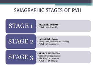 Pulmonary venous hypertension stages & skiagraphic changes | PPTX