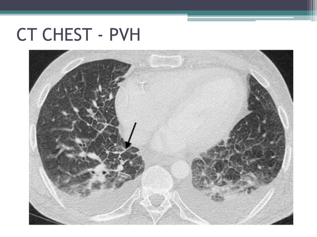 Pulmonary venous hypertension stages & skiagraphic changes | PPT