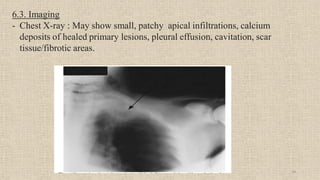 Pulmonaty Tuberclosis ((PTB) | PDF | Lung and Respiratory Health ...
