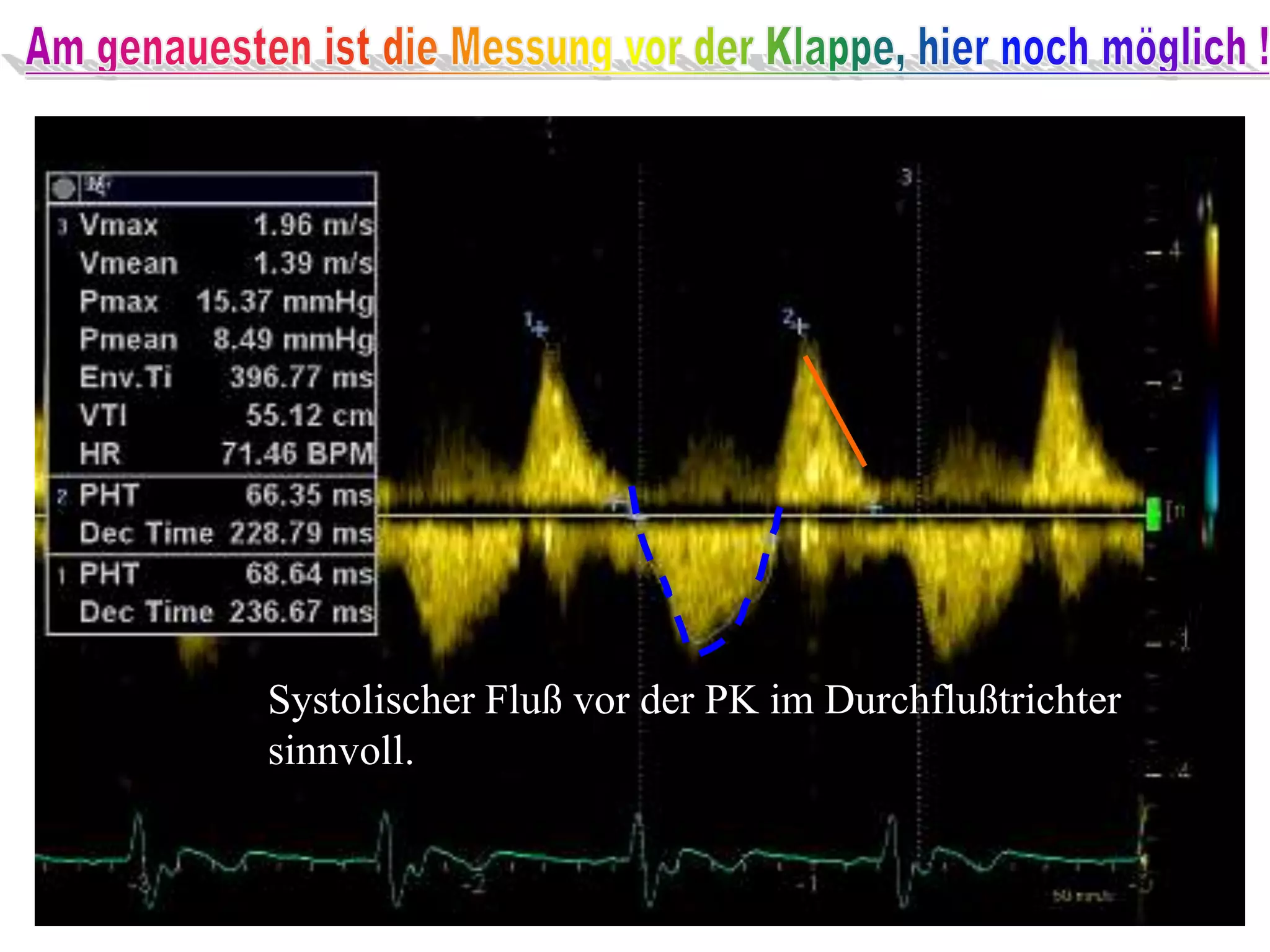 Pulmonaler Hypertonus, Teil 2. Pulmonaler Hypertonus und Bernoulli ...