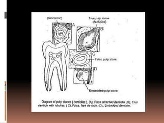 pulp-calcification.pptx