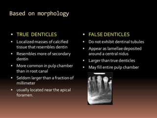 pulp-calcification.pptx