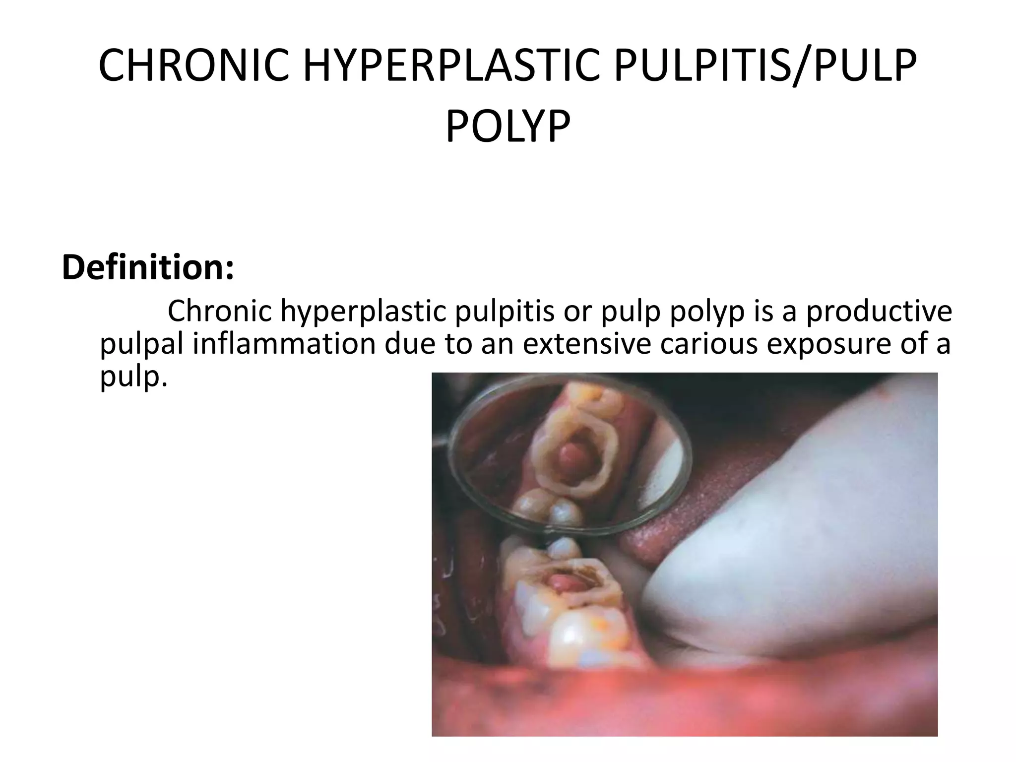 Pulpal diseases | PPTX