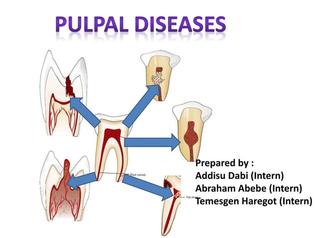 Pulpal diseases | PPTX | Dental Health | Diseases and Conditions