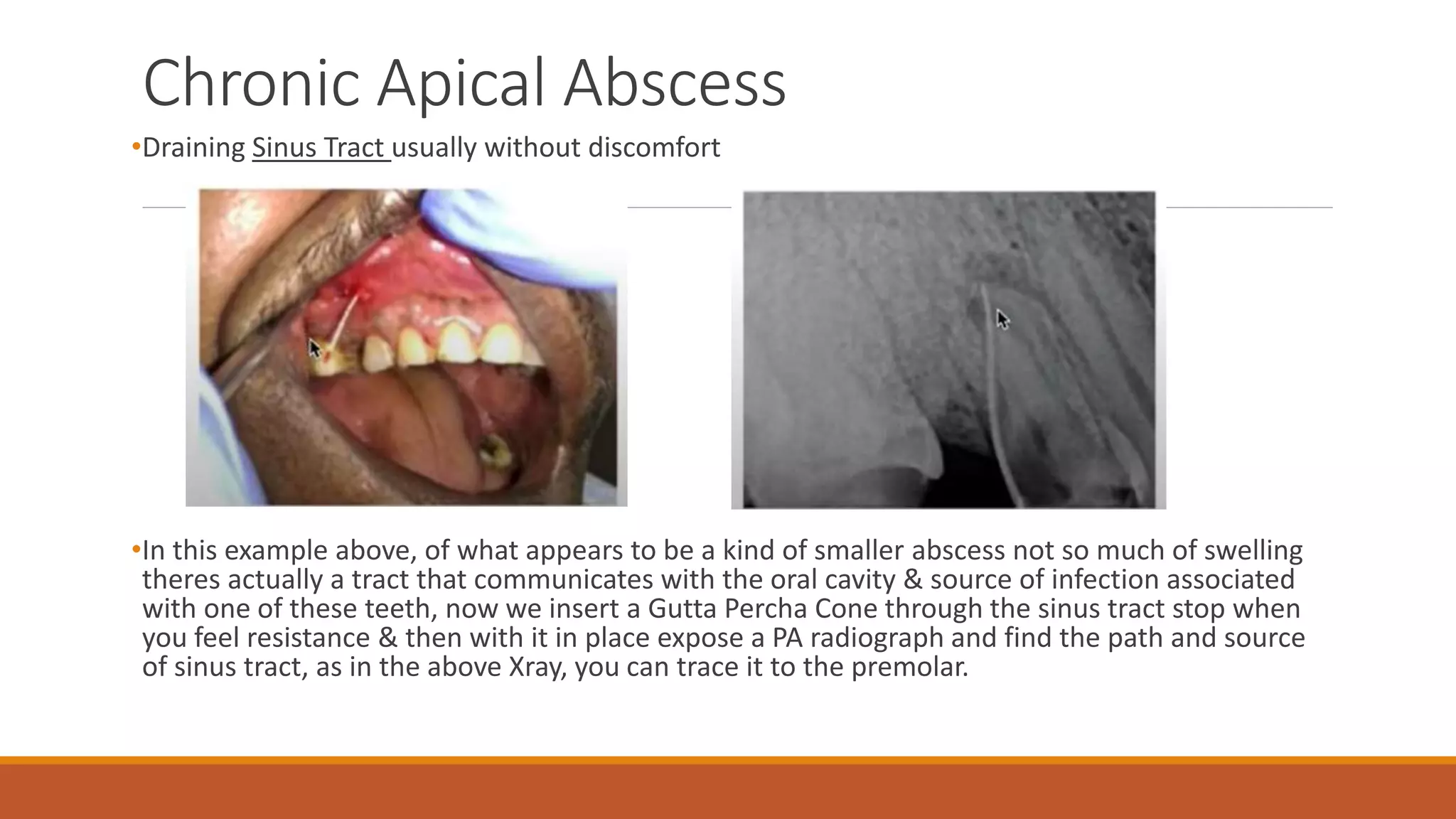 Pulpal & PeriApical Diagnosis.pptx