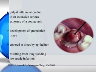 pulpalperiradiculardiseasesmodified-140511085442-phpapp02.pdf