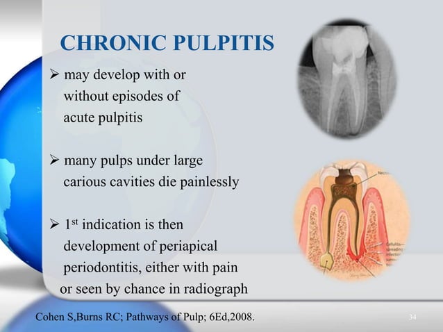 Pulpal & periradicular diseases & their diagnosis | PPTX | Dental ...