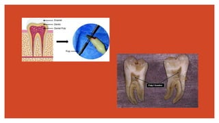 Pulpal Response To Dental Caries | PPTX