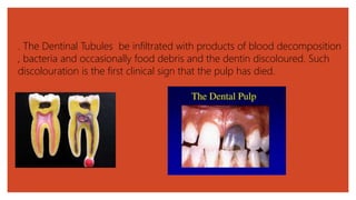 Pulpal Response To Dental Caries | PPTX