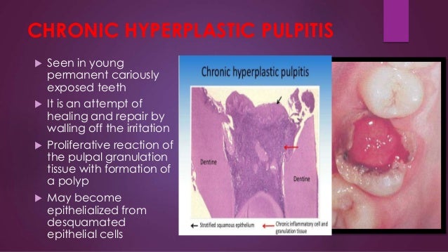 Pulp and periapical disease
