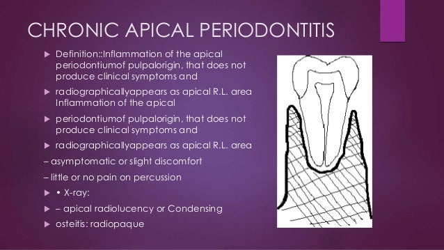 Chronic Apical Periodontitis Single Visit Rct And Post/core Placement